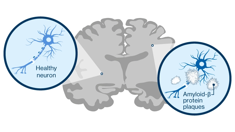 Neuroscientists target Alzheimer’s “silent stage” | Novartis