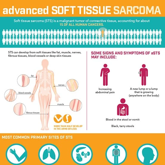 Advanced Soft Tissue Sarcoma Infographic | Novartis